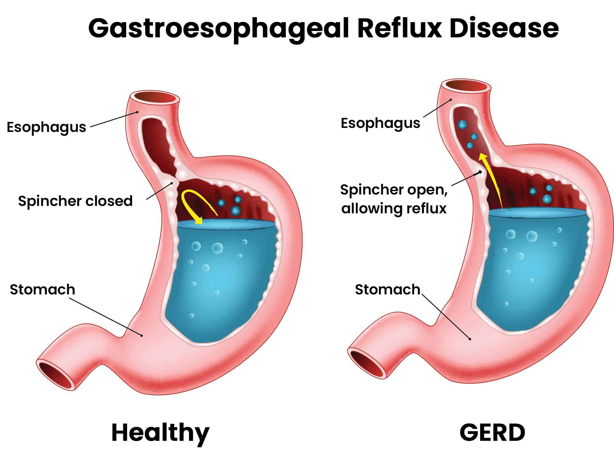 GERD (Gastroesophageal Reflux Disease) - Bahaya penyakit GERD